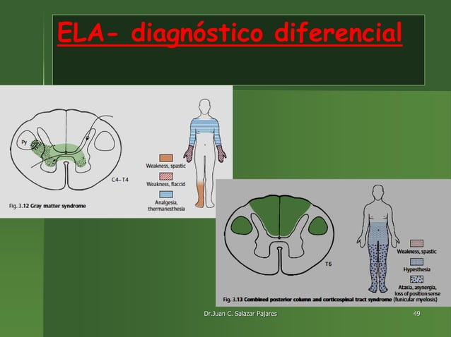 ENFERMEDADES DE LA NEURONA MOTORA - ESCLEROSIS LATERAL AMIOTROFICA (ELA ...