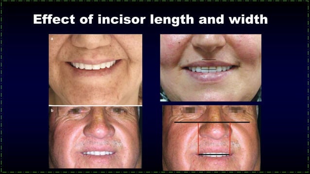 12- Denture processing and laboratory errors | PPTX | Dental Health | Diseases and Conditions