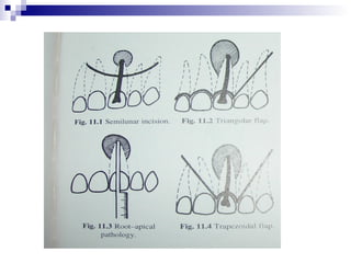 12 endodontic surgical procedures | PPT