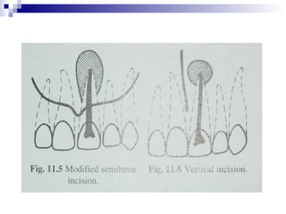 12 endodontic surgical procedures | PPT