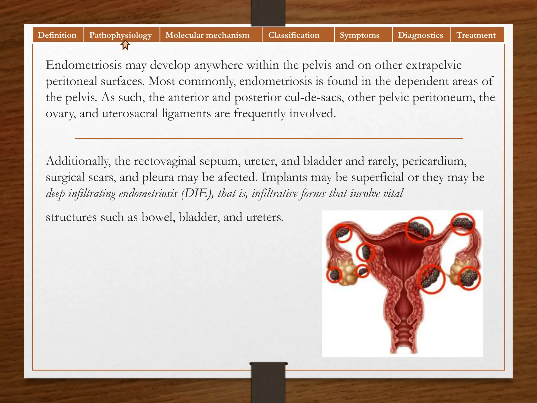 12-------+++++++++++++ Endometriosis.pptx | Pregnancy | Reproductive Health