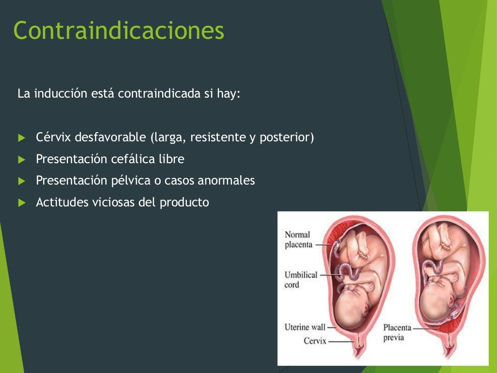 12 inducción del trabajo de parto con oxitocina