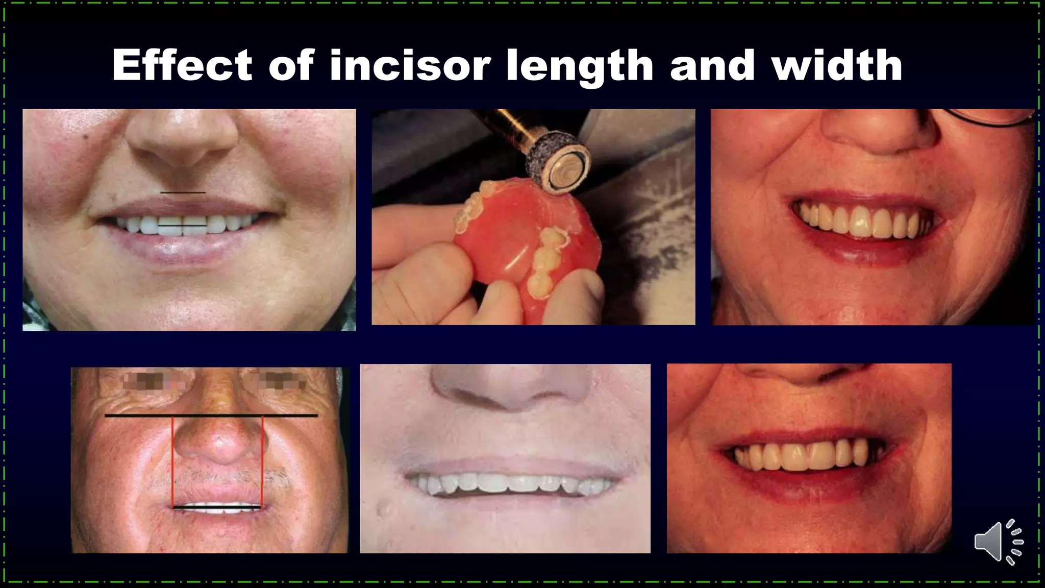 12- Denture Processing and Laboratory Errors. | PPTX