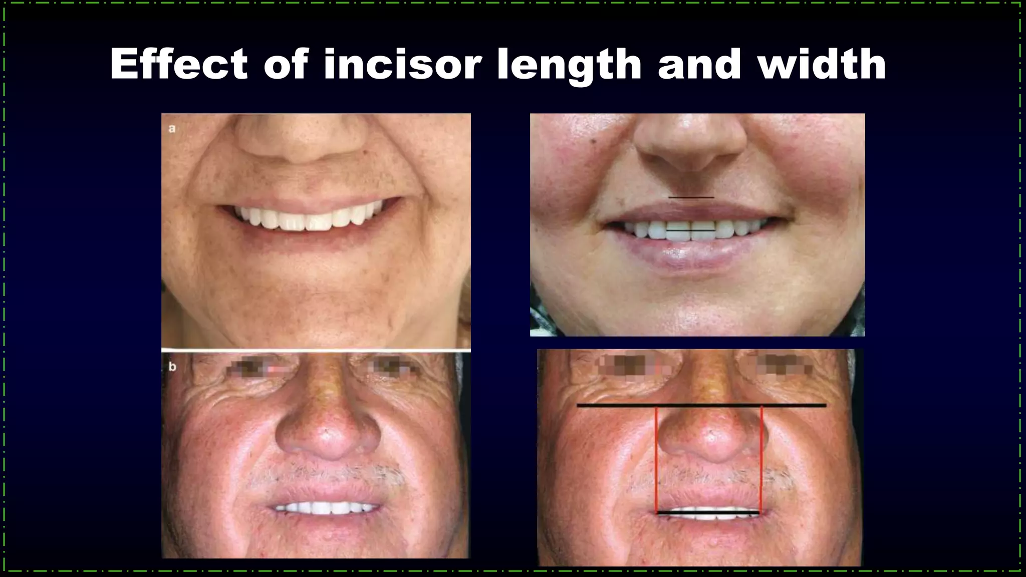 12- Denture Processing and Laboratory Errors. | PPTX