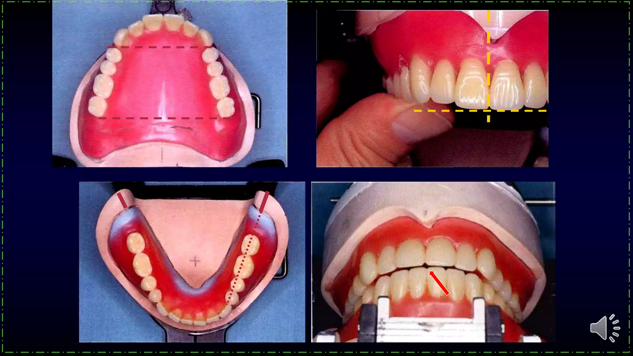 12- Denture Processing and Laboratory Errors. | PPTX