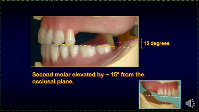 12- Denture Processing and Laboratory Errors. | PPTX