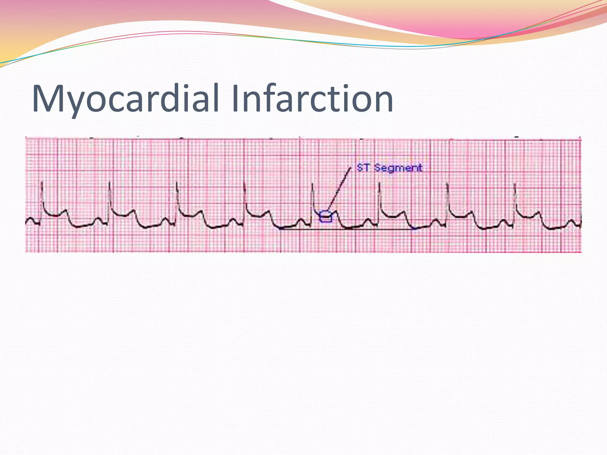 12 Lead EKG Interpretation | PPTX | Heart and Cardiovascular Diseases ...