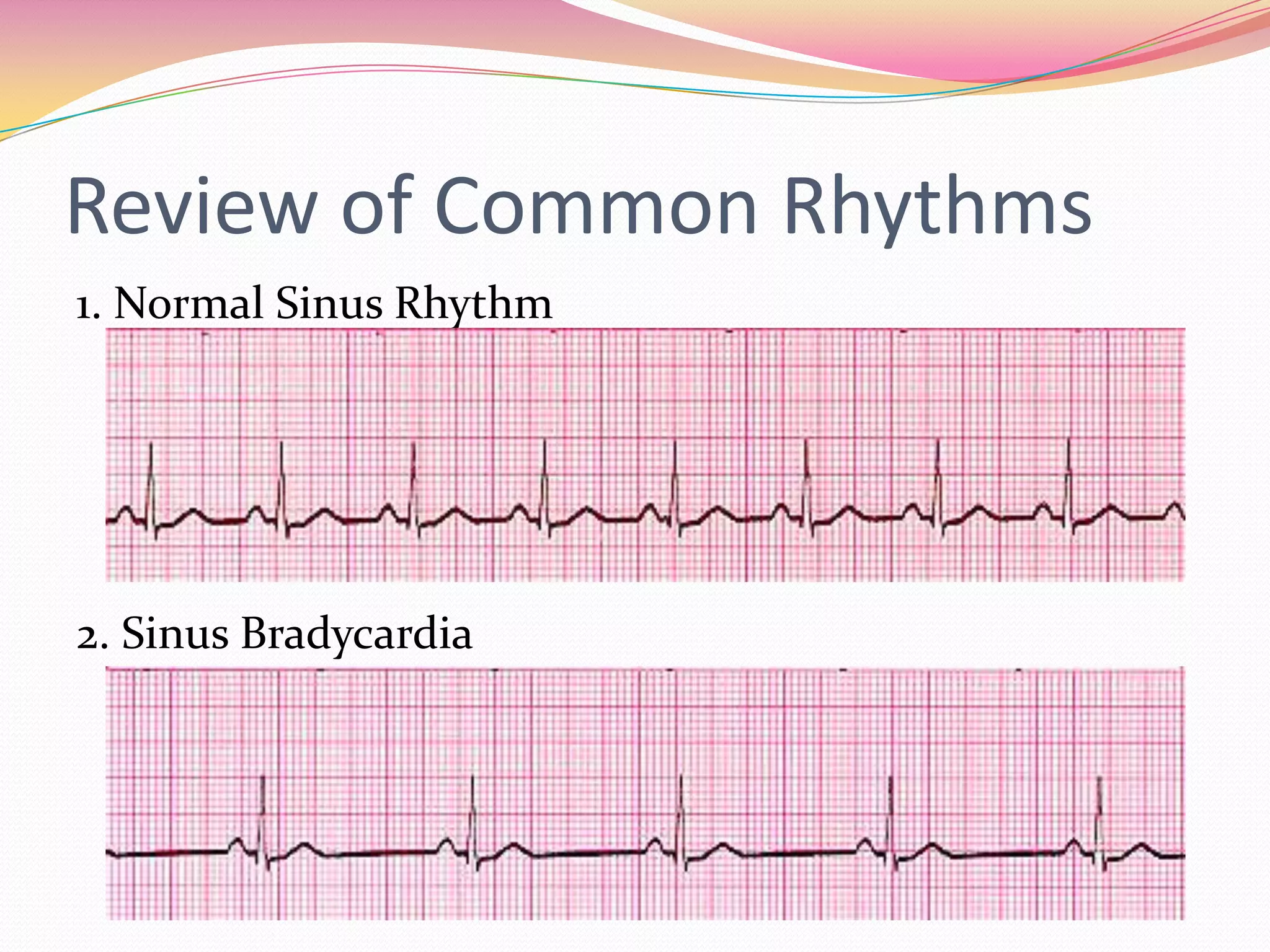 12 Lead EKG Interpretation | PPTX