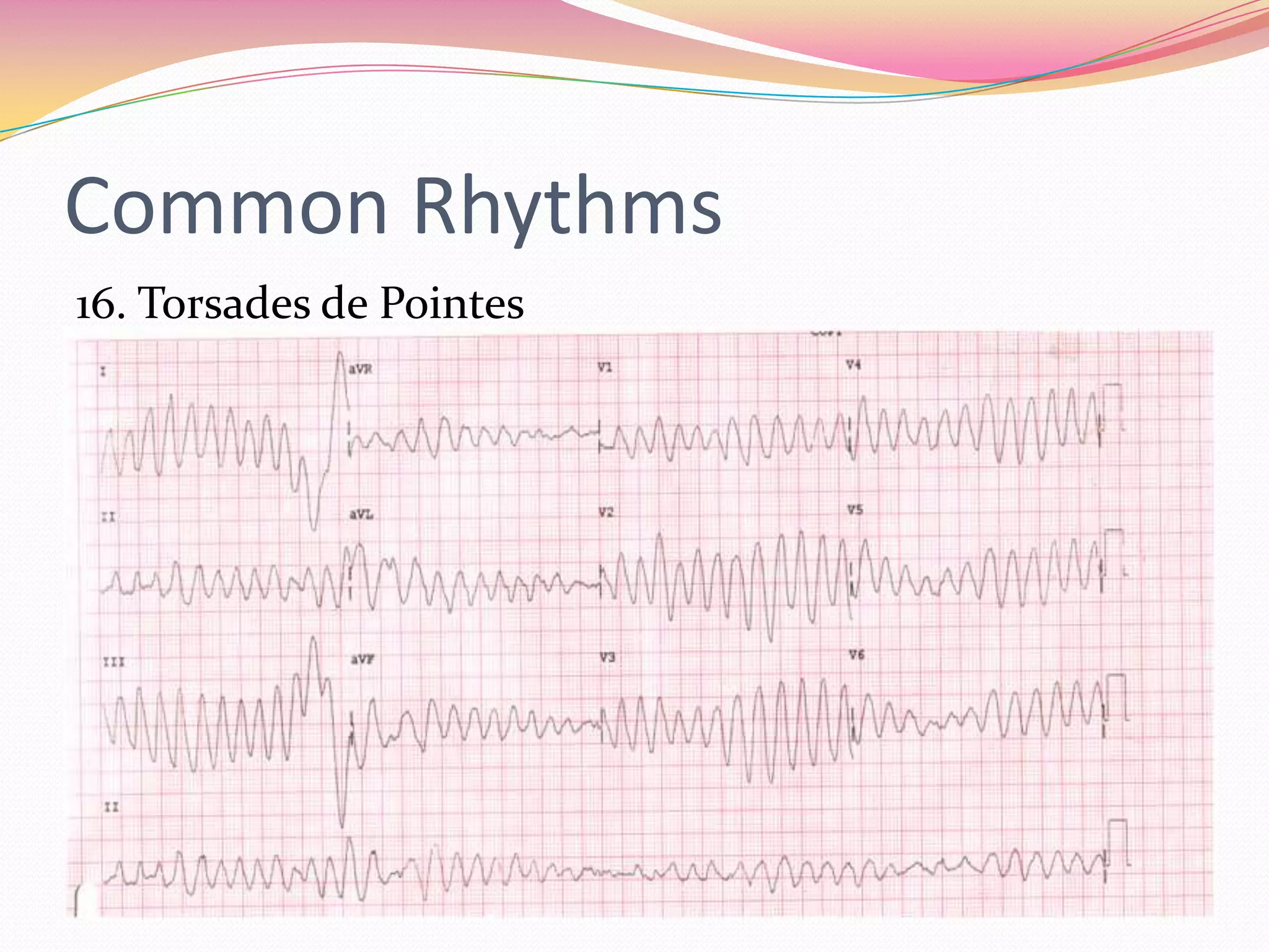 12 Lead EKG Interpretation | PPTX