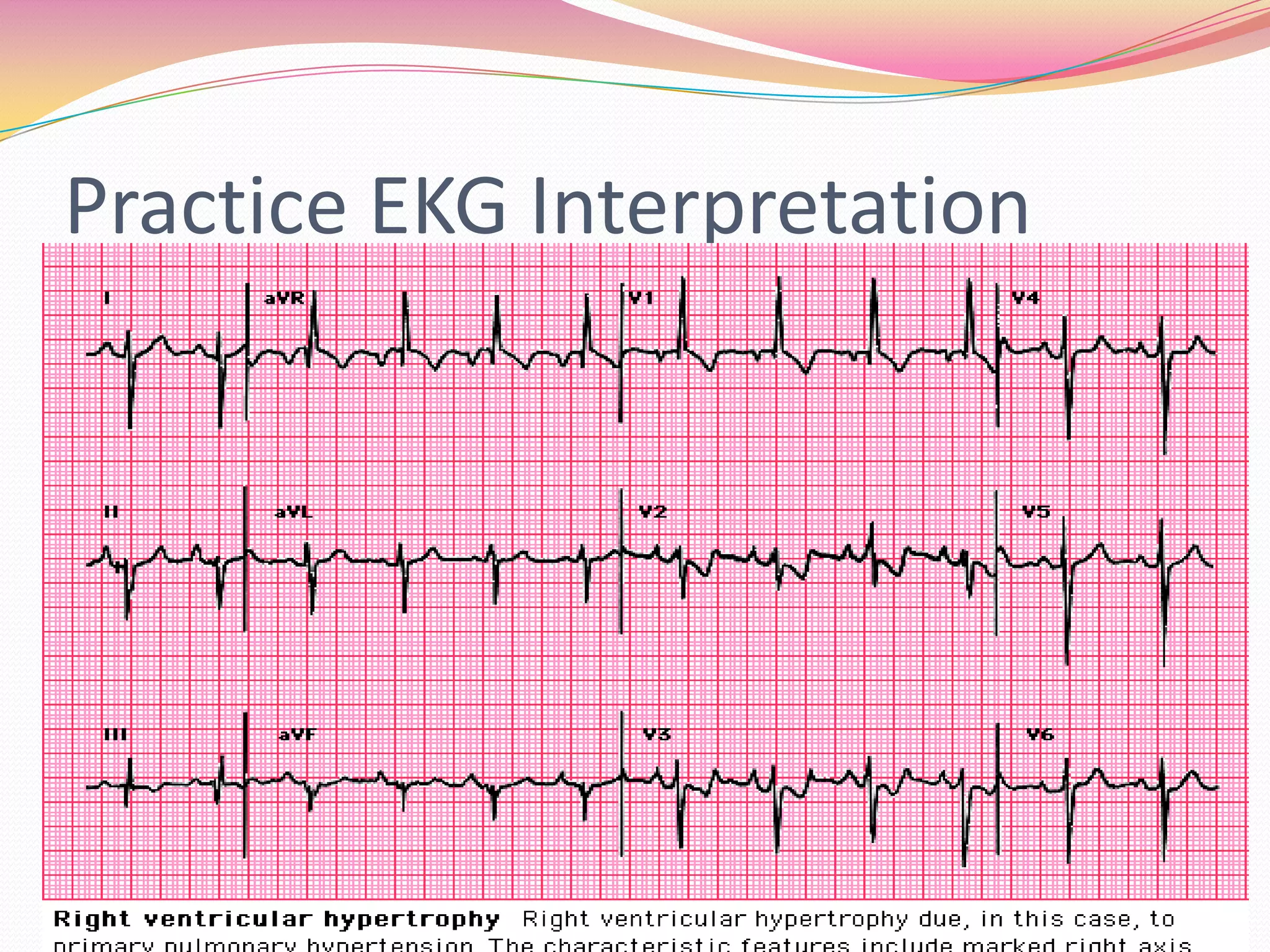 12 Lead EKG Interpretation | PPTX