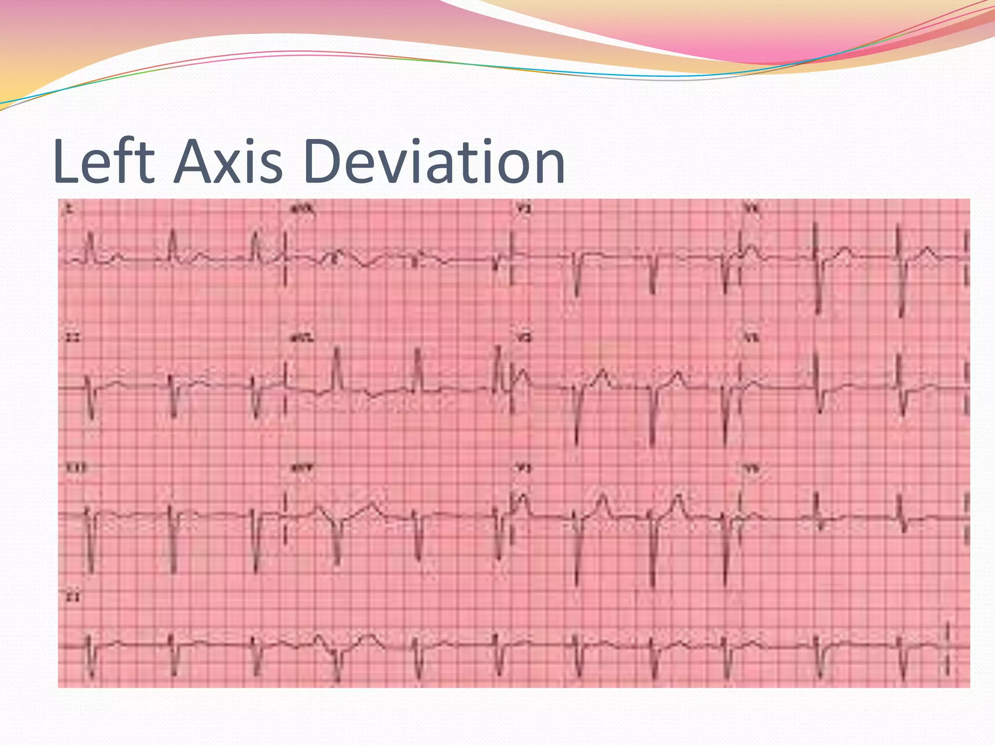 12 Lead EKG Interpretation | PPTX
