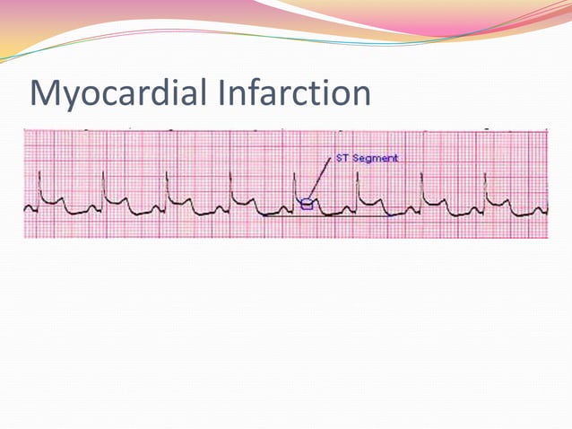 12 Lead EKG Interpretation | PPTX | Heart and Cardiovascular Diseases ...