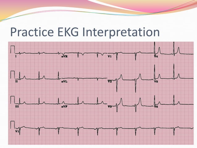 12 Lead EKG Interpretation | PPTX | Heart and Cardiovascular Diseases ...
