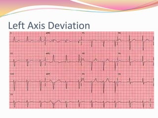 12 Lead EKG Interpretation | PPTX