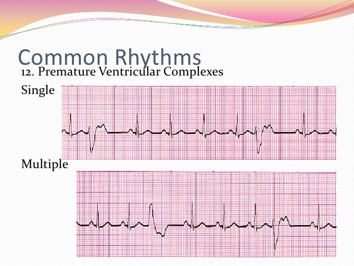 12 Lead EKG Interpretation