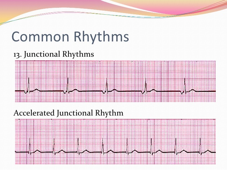 12 Lead EKG Interpretation