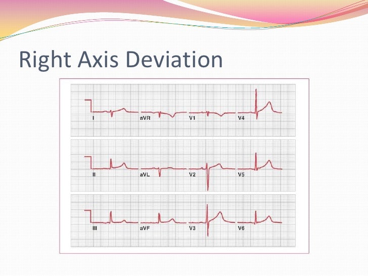 12 Lead EKG Interpretation