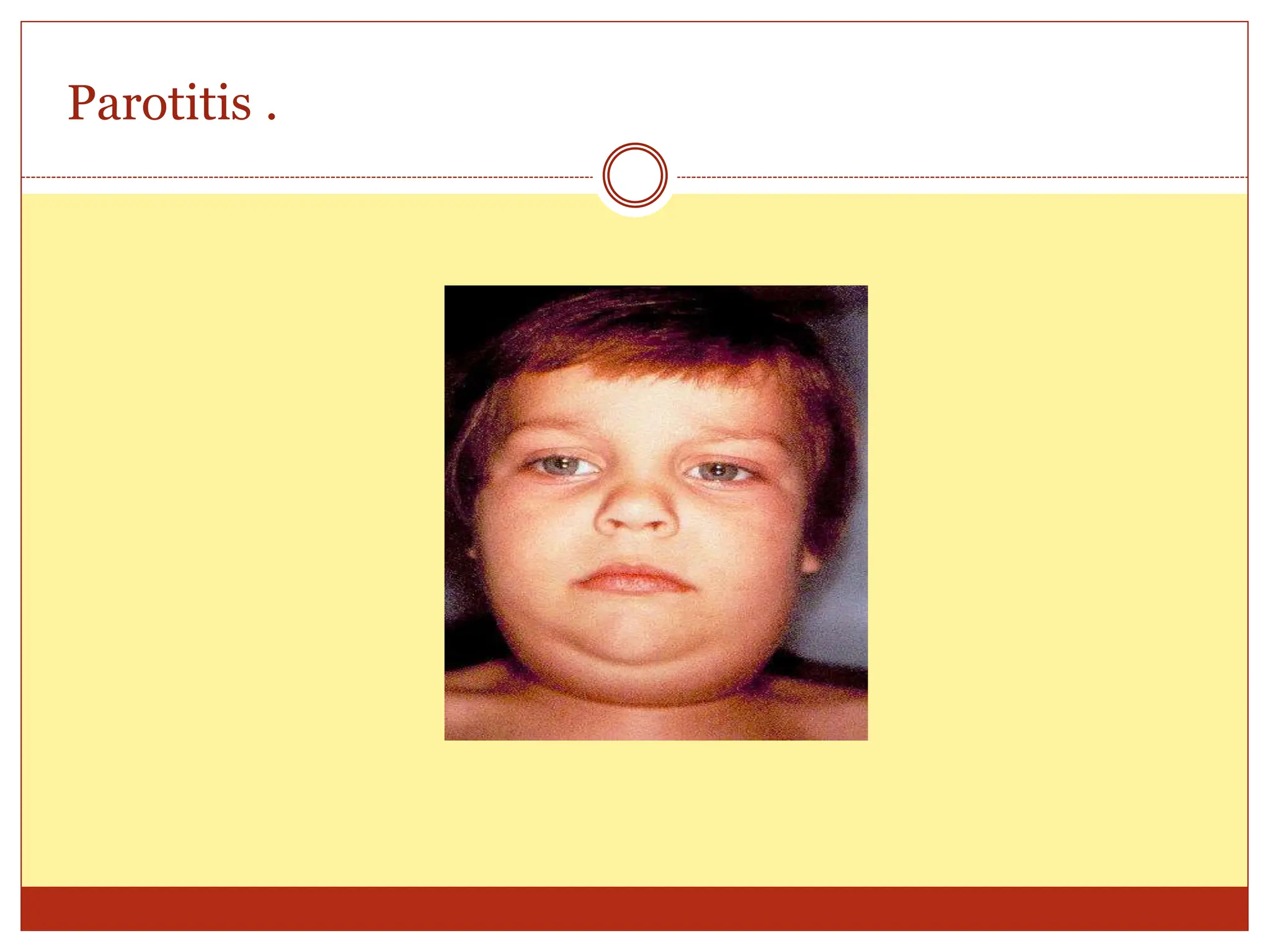 12 Mumps (parotitis) gendongan pada anak | PPT | Ear, Nose and Throat ...