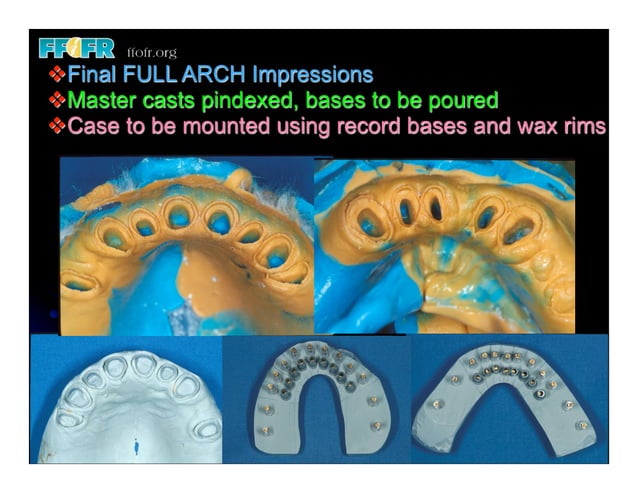 12.(new)surveyed crowns and combined fixed rpd cases | PDF