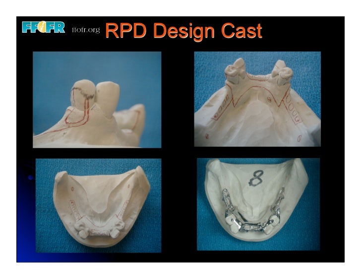 12.(new)surveyed crowns and combined fixed rpd cases