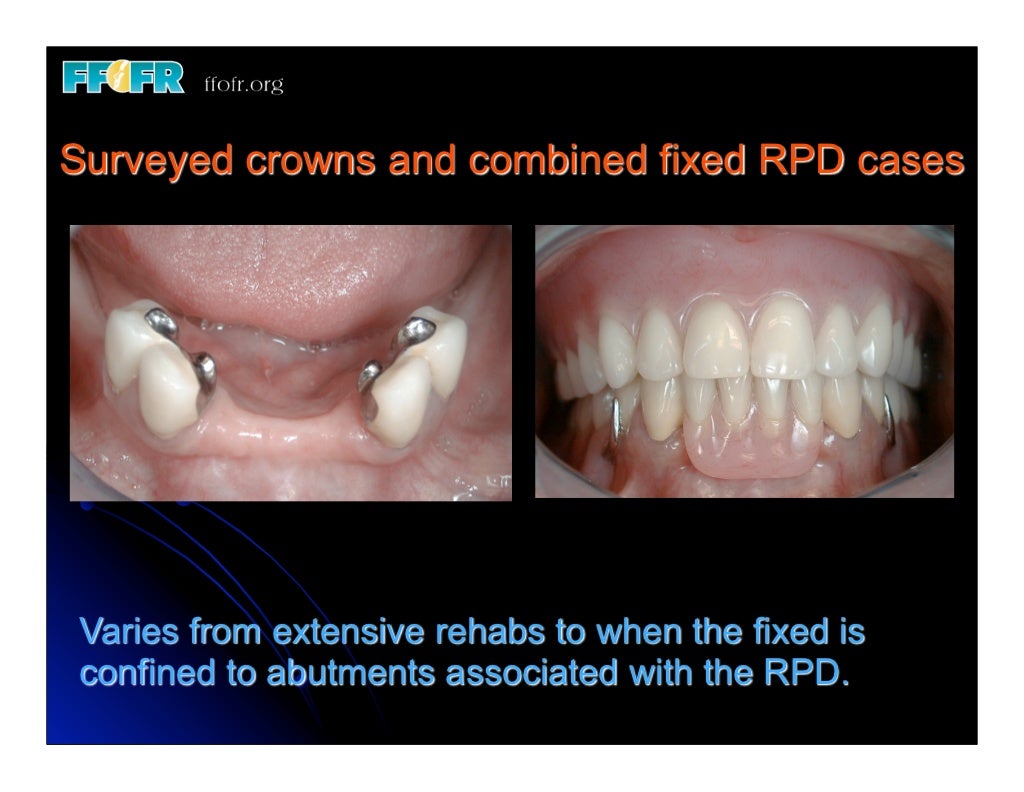 12.(new)surveyed crowns and combined fixed rpd cases