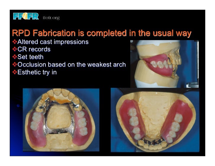 12.(new)surveyed crowns and combined fixed rpd cases