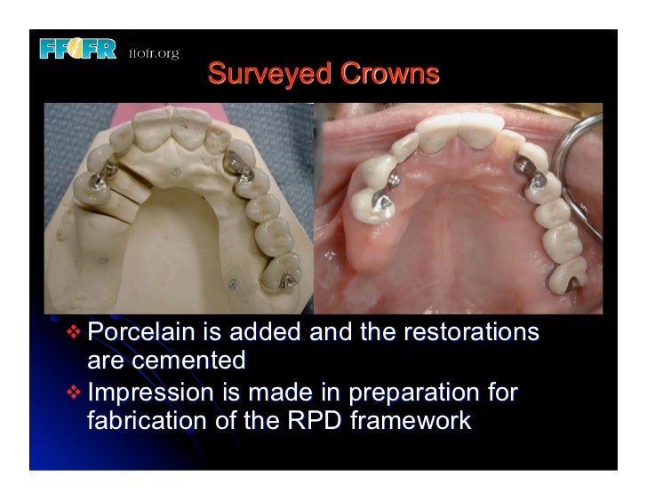 12.(new)surveyed crowns and combined fixed rpd cases