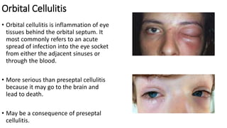 12-Ocular emergencies and common eye disorders.pptx