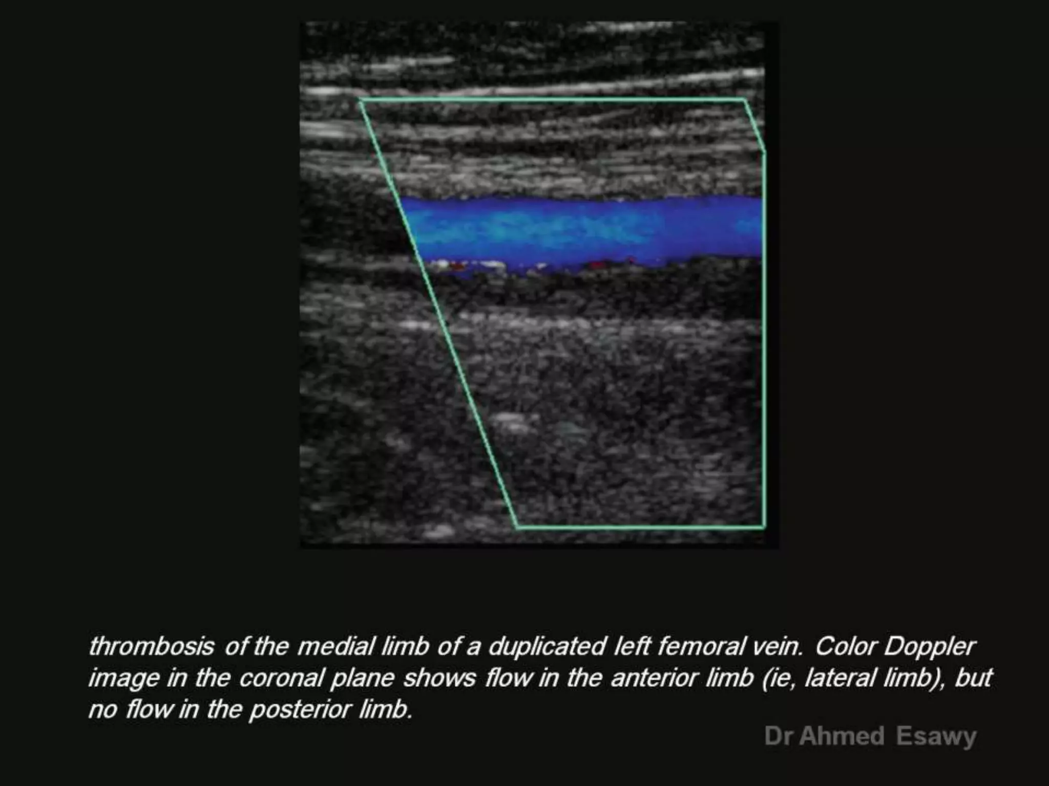 12 peripheral venous duplex pitfalls differential diagnosis dvt dr ...