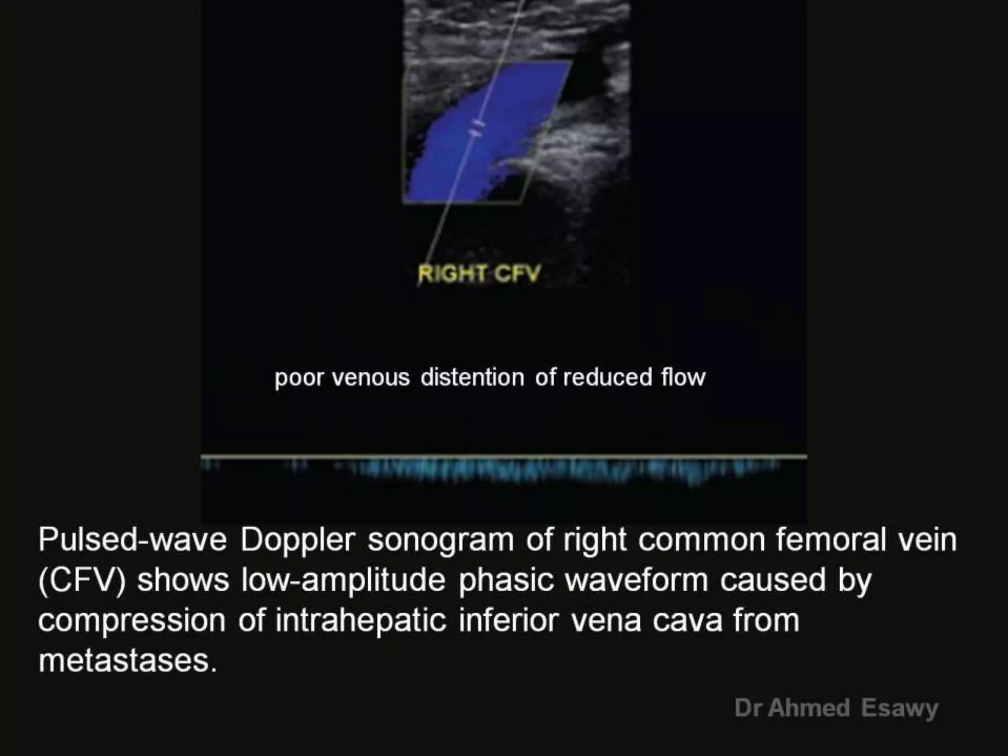 12 peripheral venous duplex pitfalls differential diagnosis dvt dr ...