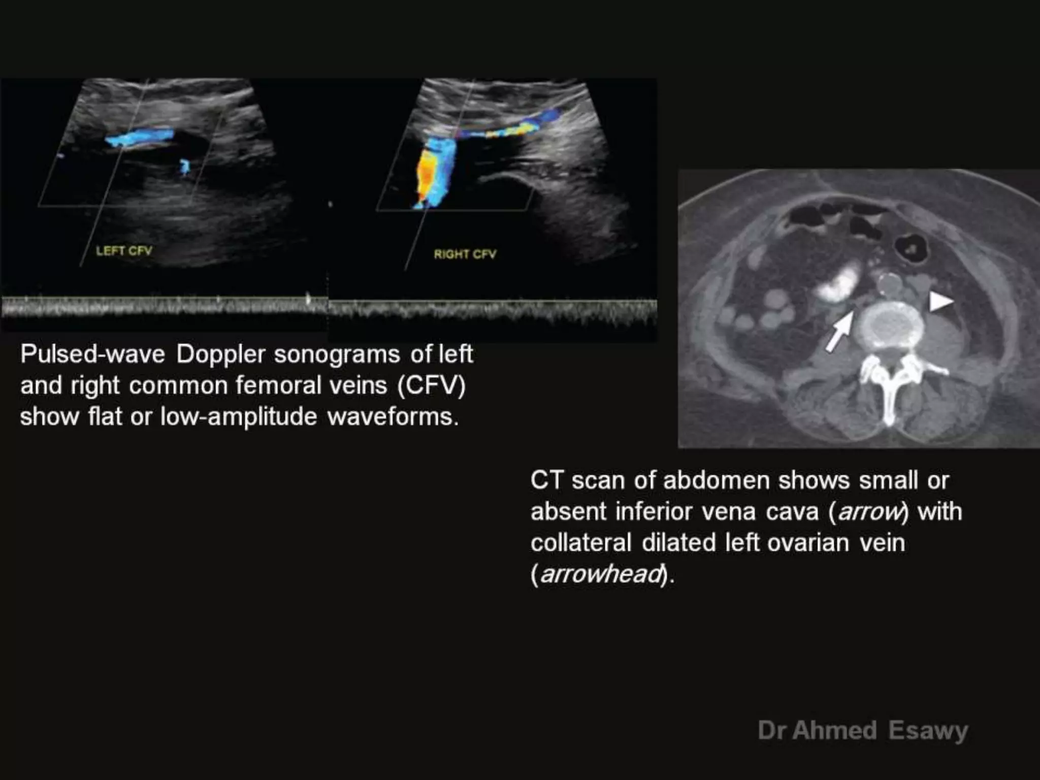 12 peripheral venous duplex pitfalls differential diagnosis dvt dr ...