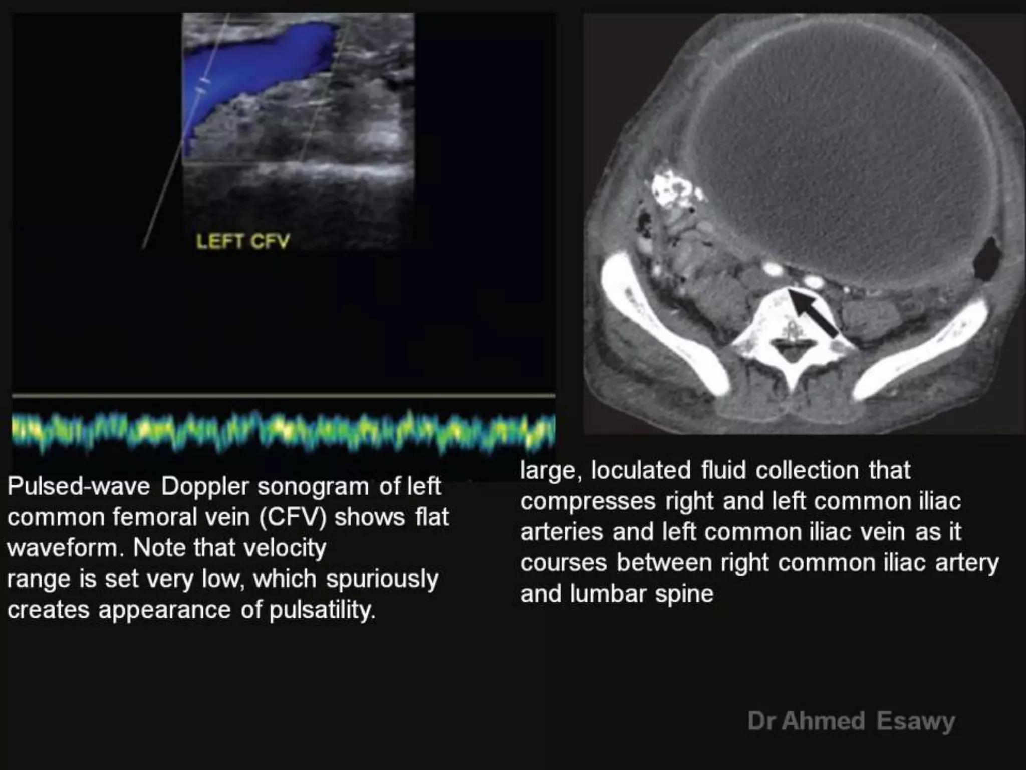 12 peripheral venous duplex pitfalls differential diagnosis dvt dr ...
