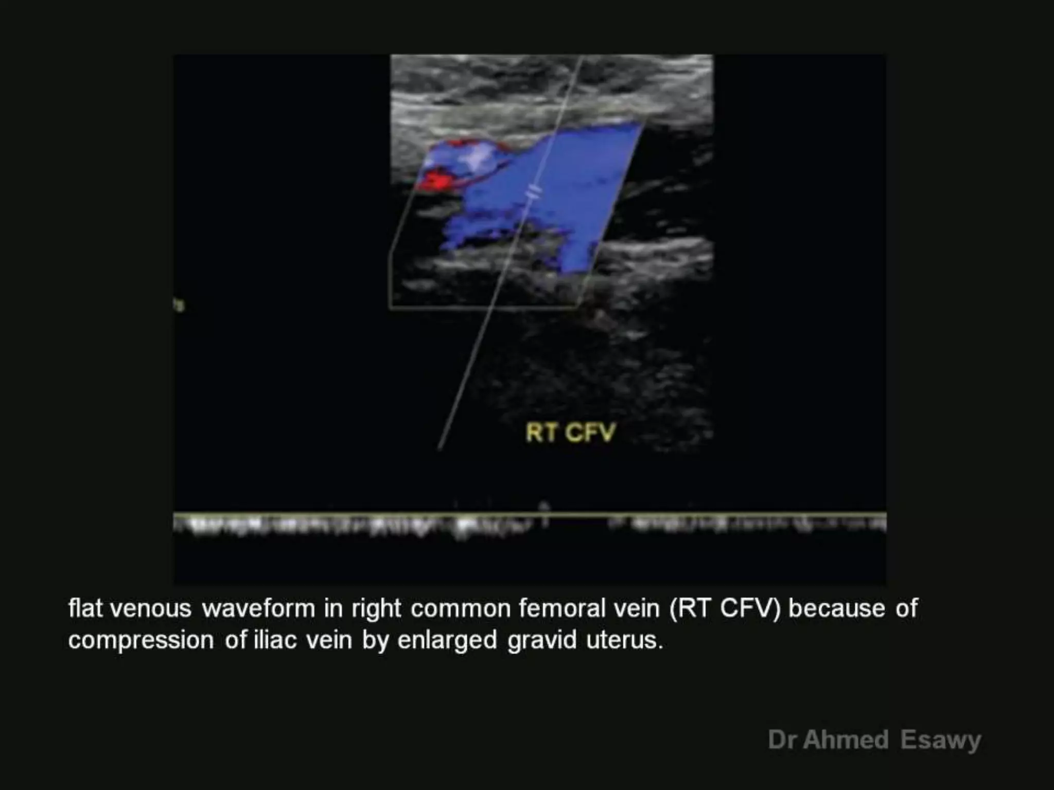 12 peripheral venous duplex pitfalls differential diagnosis dvt dr ...