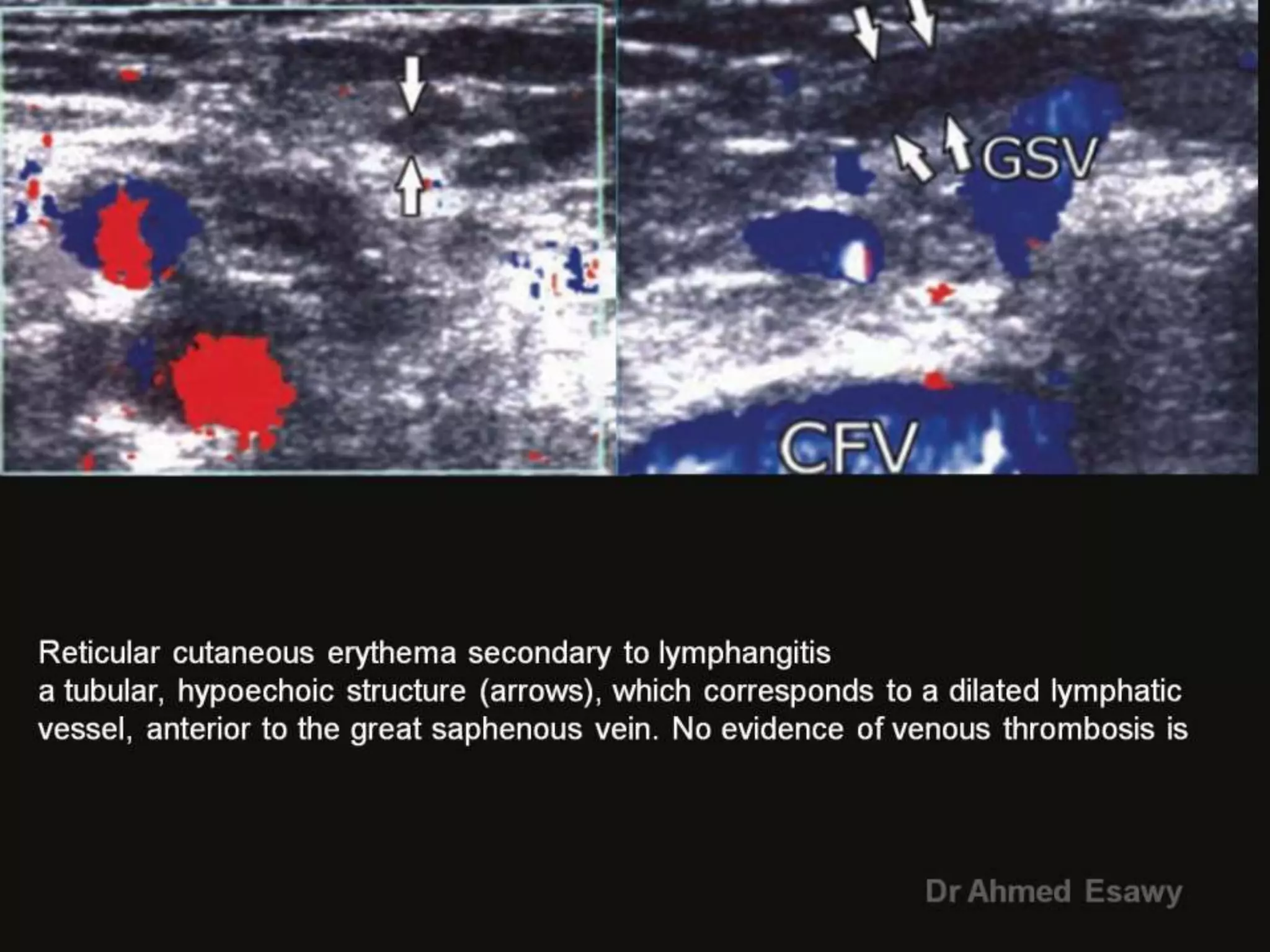 12 peripheral venous duplex pitfalls differential diagnosis dvt dr ...