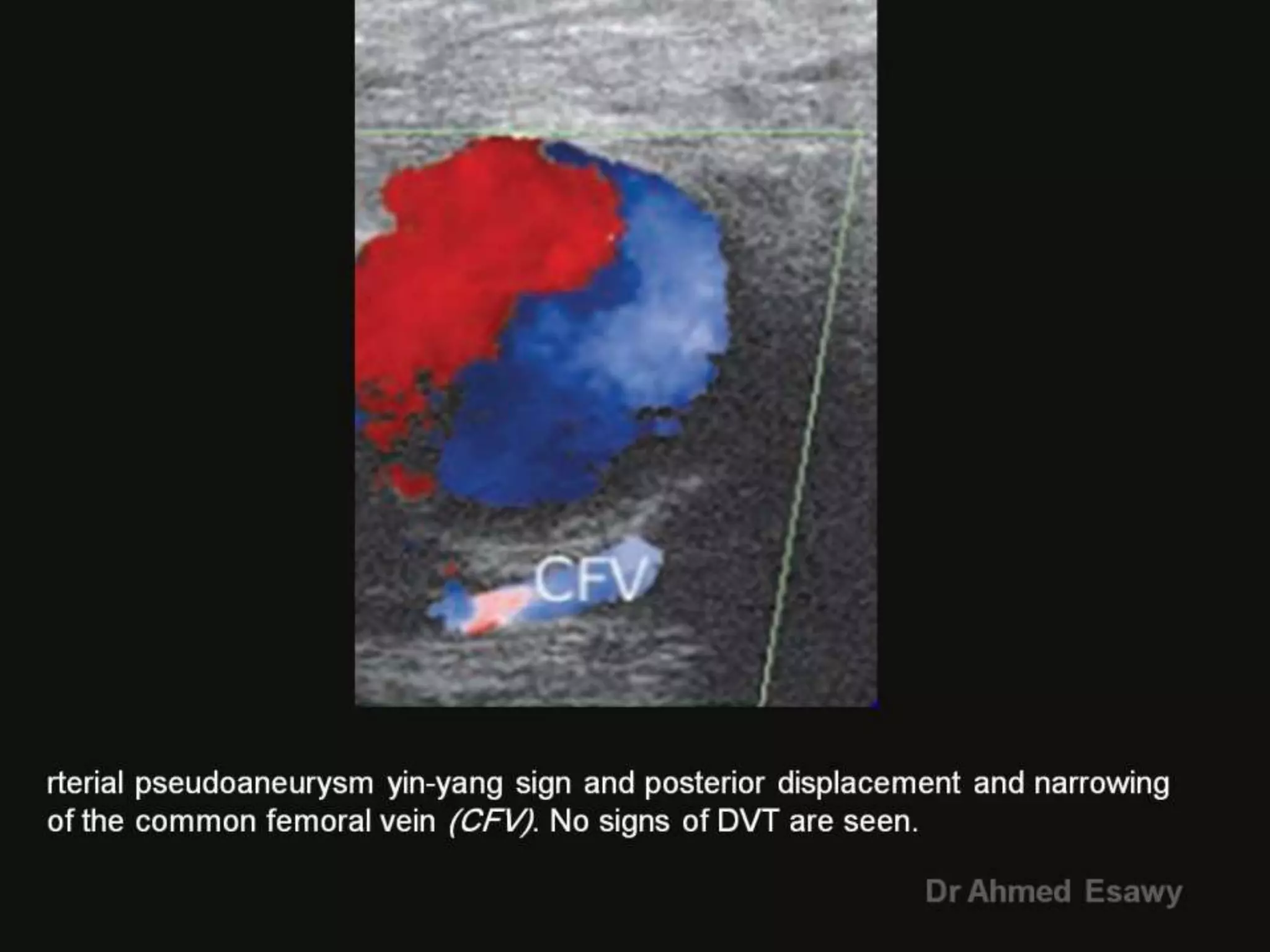 12 peripheral venous duplex pitfalls differential diagnosis dvt dr ...