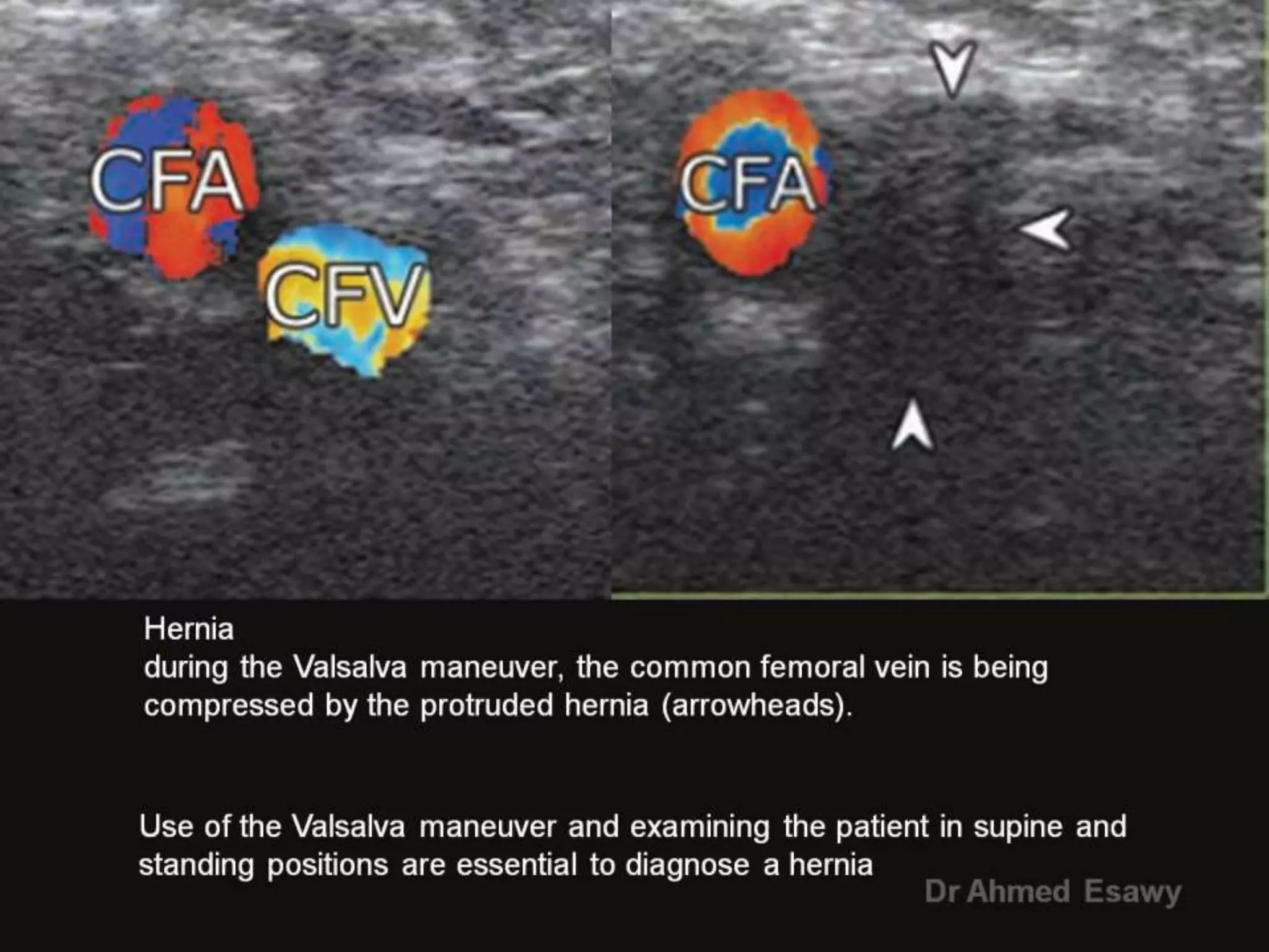 12 peripheral venous duplex pitfalls differential diagnosis dvt dr ...