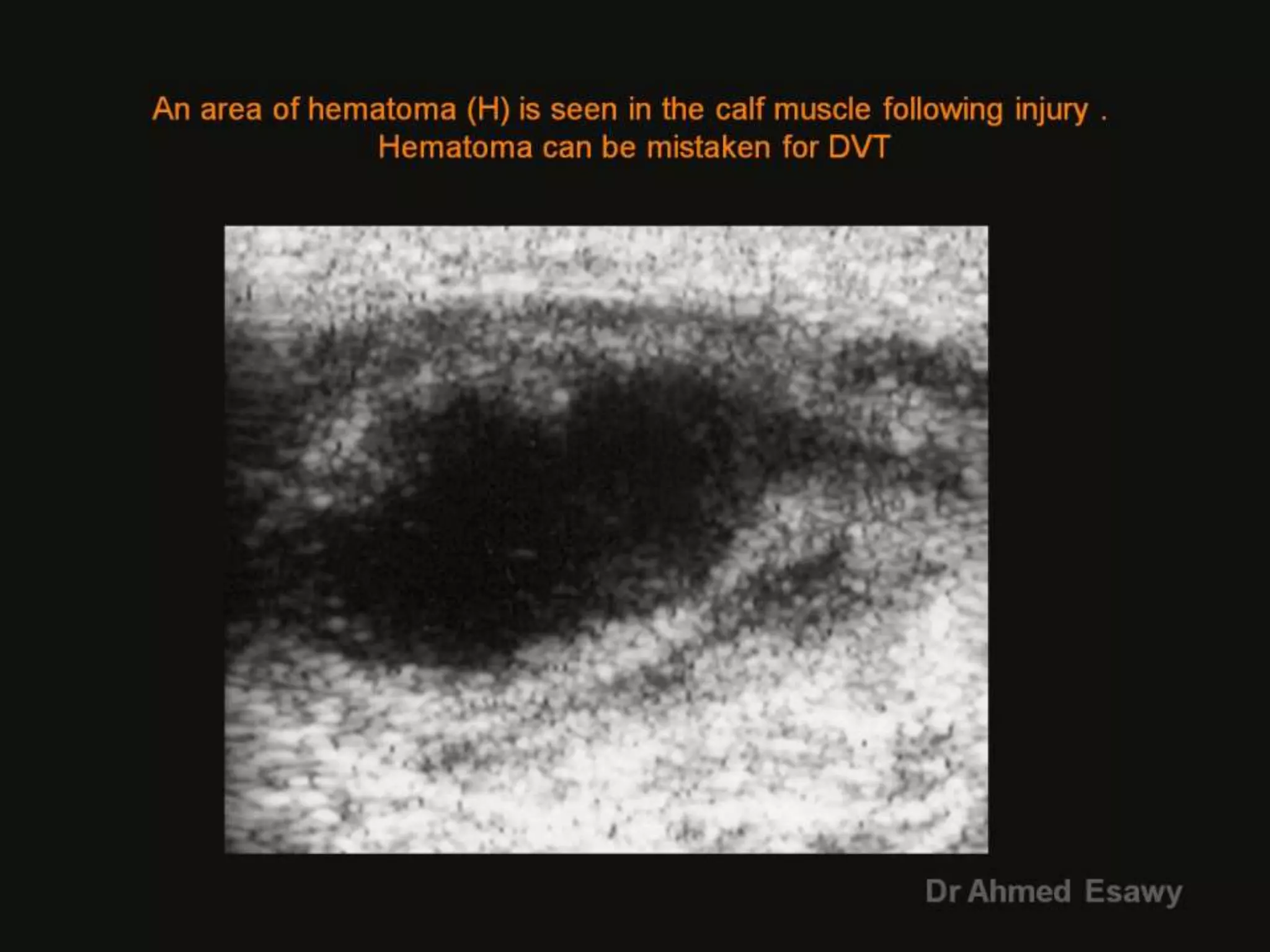 12 peripheral venous duplex pitfalls differential diagnosis dvt dr ...