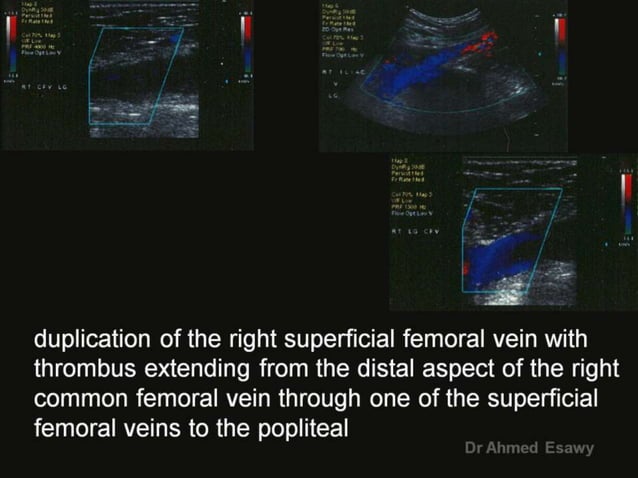 12 peripheral venous duplex pitfalls differential diagnosis dvt dr ...