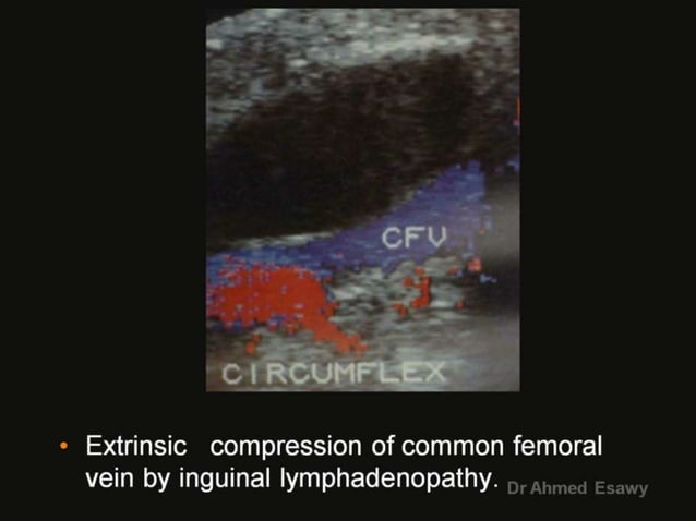12 peripheral venous duplex pitfalls differential diagnosis dvt dr ...