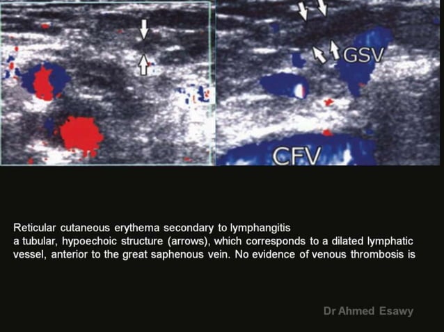 12 peripheral venous duplex pitfalls differential diagnosis dvt dr ...