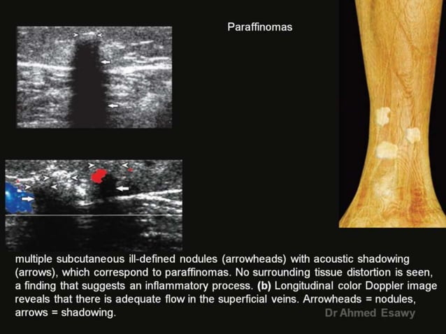 12 peripheral venous duplex pitfalls differential diagnosis dvt dr ...
