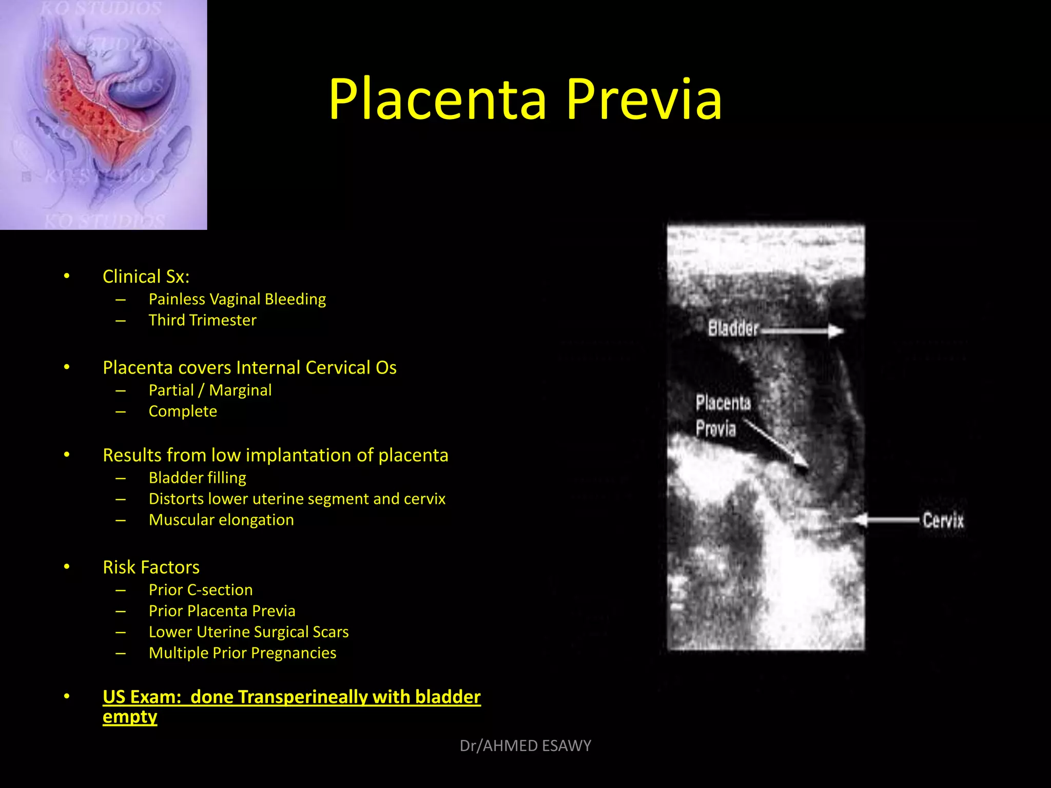 12-placenta imaging Dr Ahmed Esawy | PDF