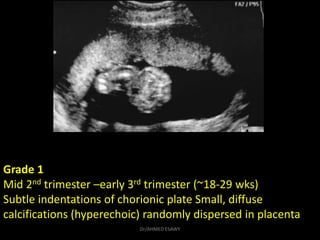 Chorionic Plate Ultrasound