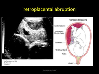 Retroplacental Bleeding