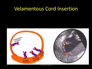 Velamentous Cord Insertion Ultrasound