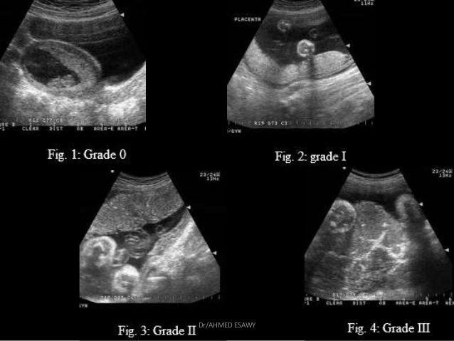 12-placenta imaging Dr Ahmed Esawy
