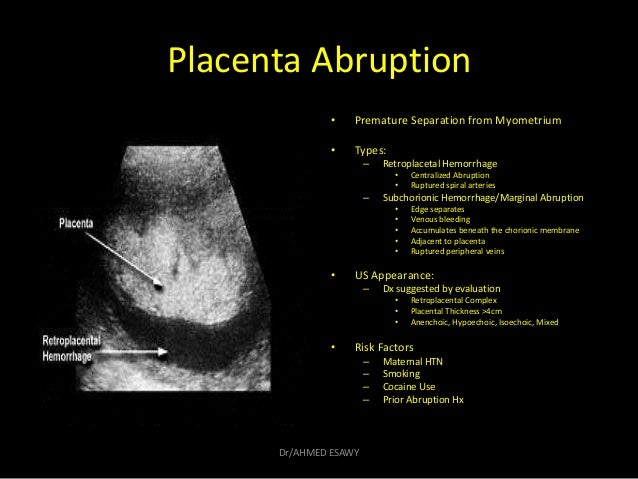 12-placenta imaging Dr Ahmed Esawy