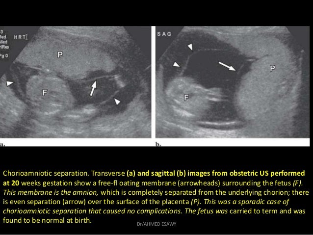 12-placenta imaging Dr Ahmed Esawy