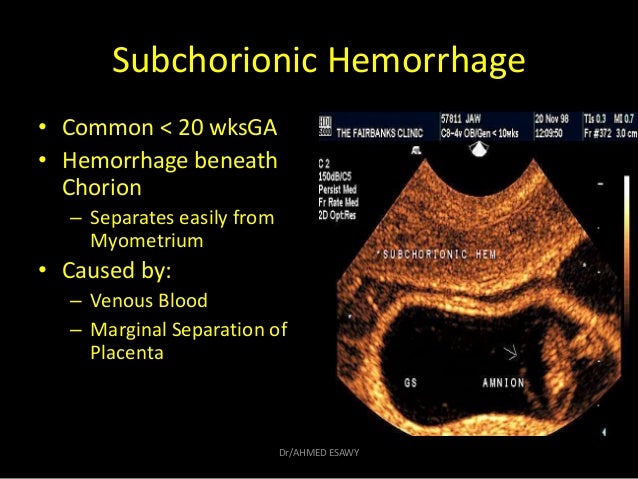 12-placenta imaging Dr Ahmed Esawy