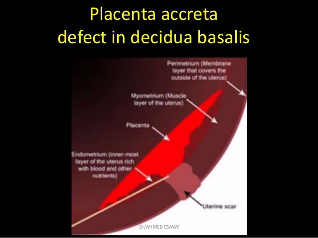 12-placenta imaging Dr Ahmed Esawy